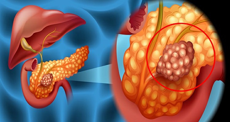 Tumor de pâncreas é um dos mais letais e demora a apresentar sintomas ...